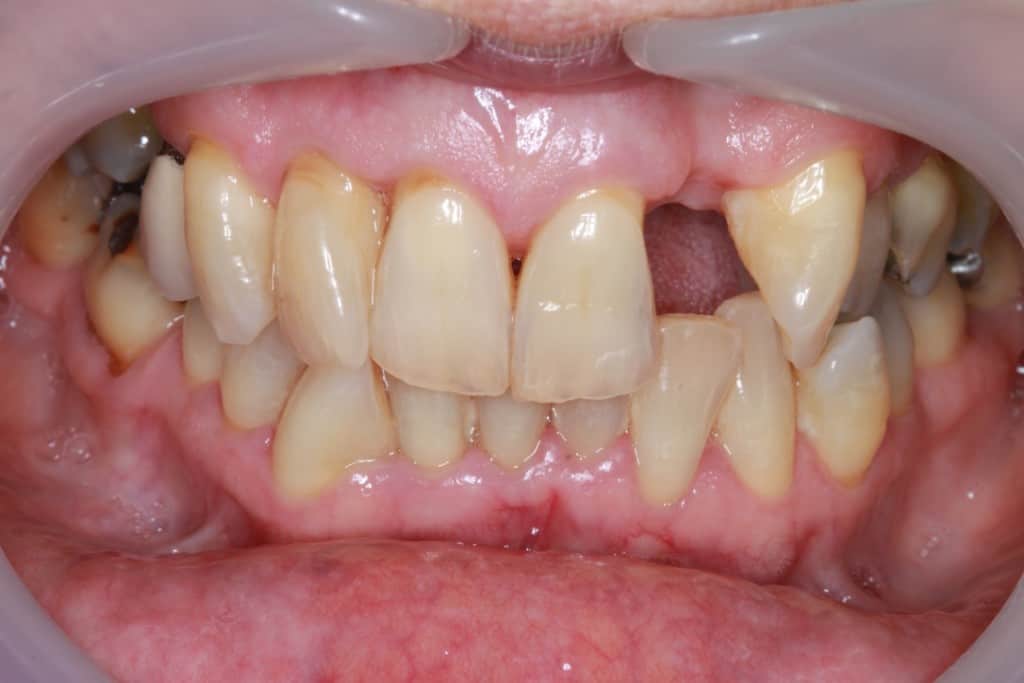 Dental Bridges - Sharrow Vale Dental Care