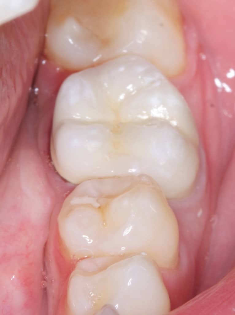 Dental Crowns - Sharrow Vale Dental Care