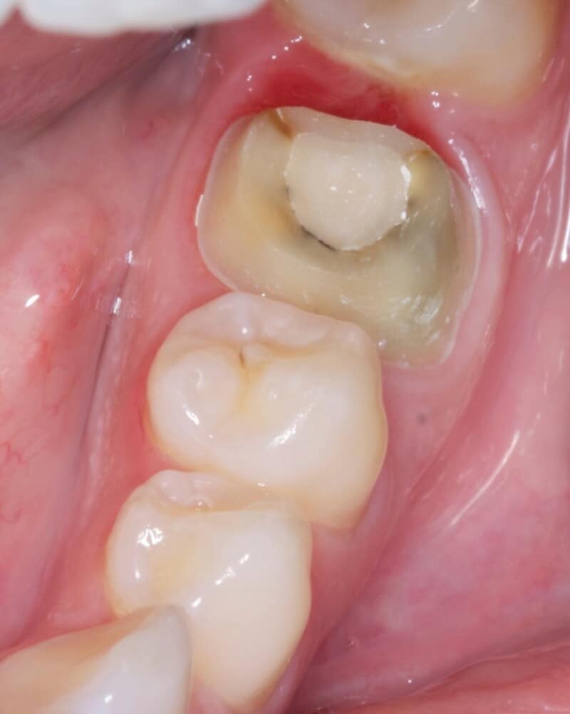 Dental Crowns - Sharrow Vale Dental Care