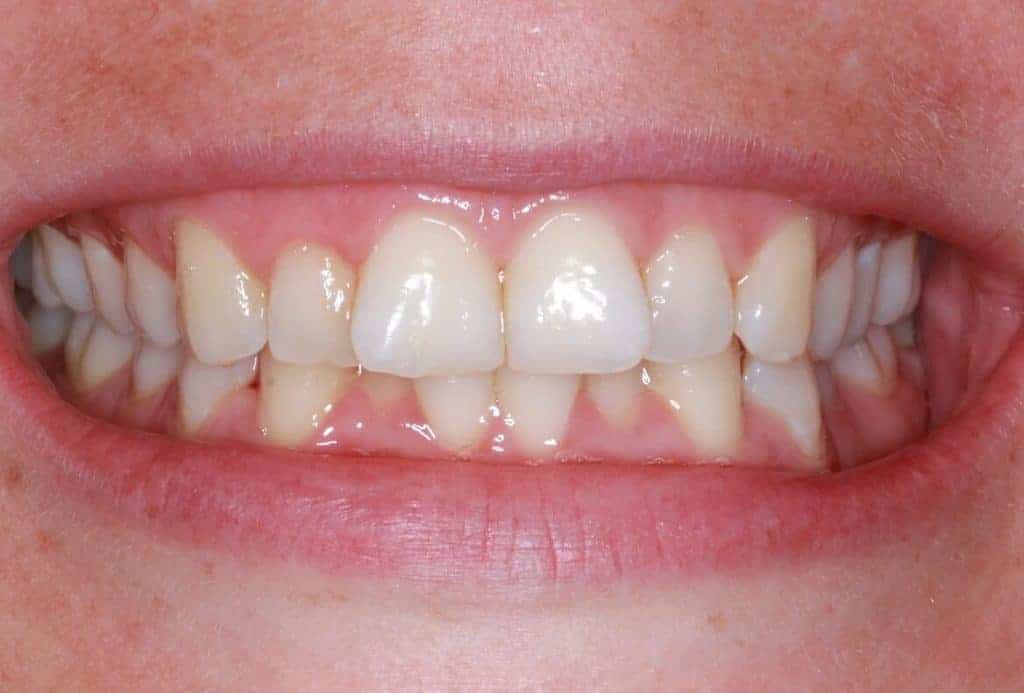 Invisalign® - Sharrow Vale Dental Care