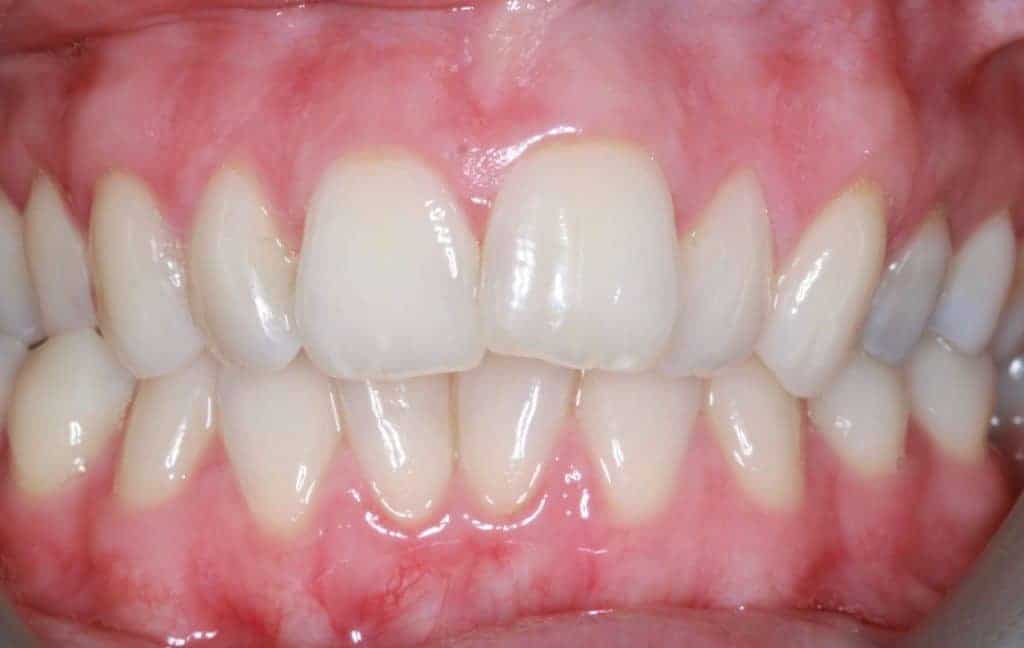 Invisalign® - Sharrow Vale Dental Care