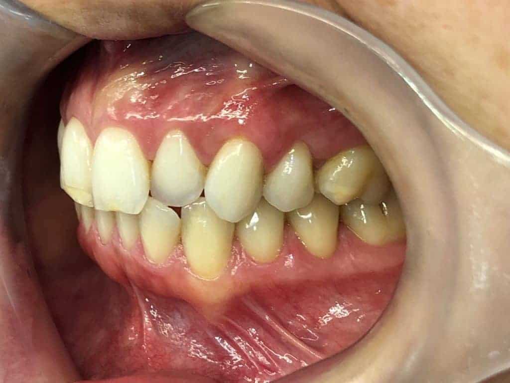 Invisalign® - Sharrow Vale Dental Care
