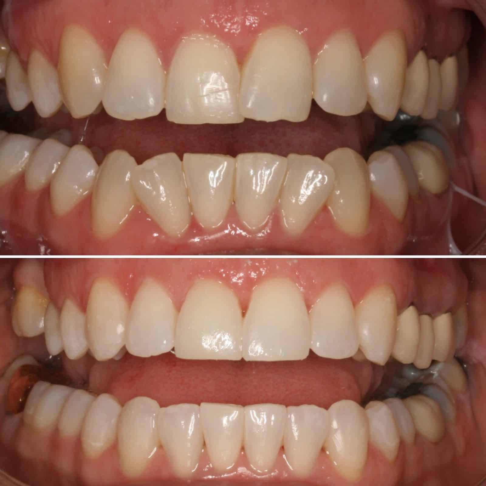 Invisalign® - Sharrow Vale Dental Care