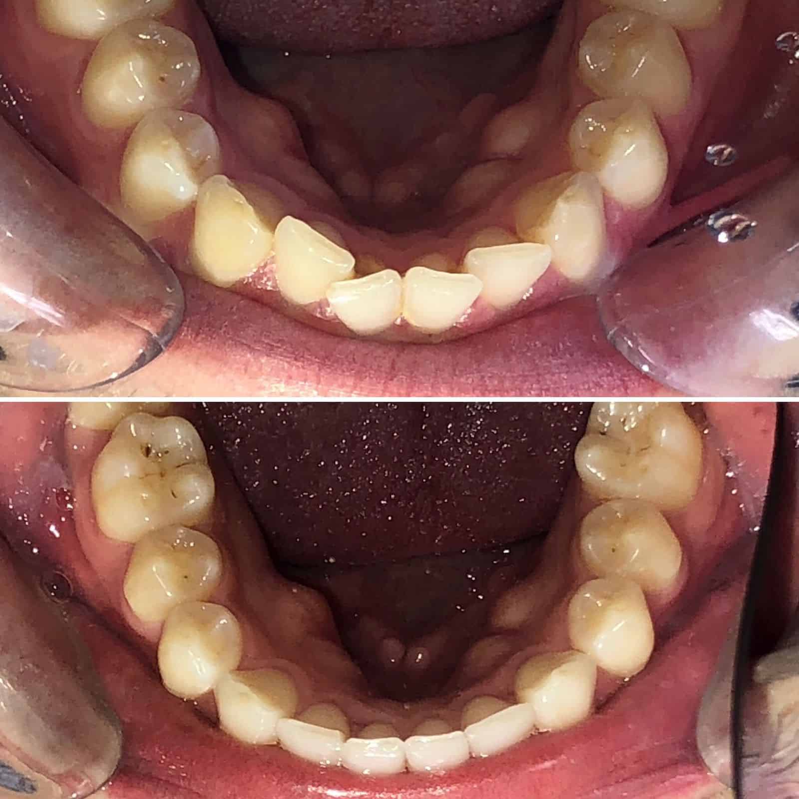 Invisalign® - Sharrow Vale Dental Care