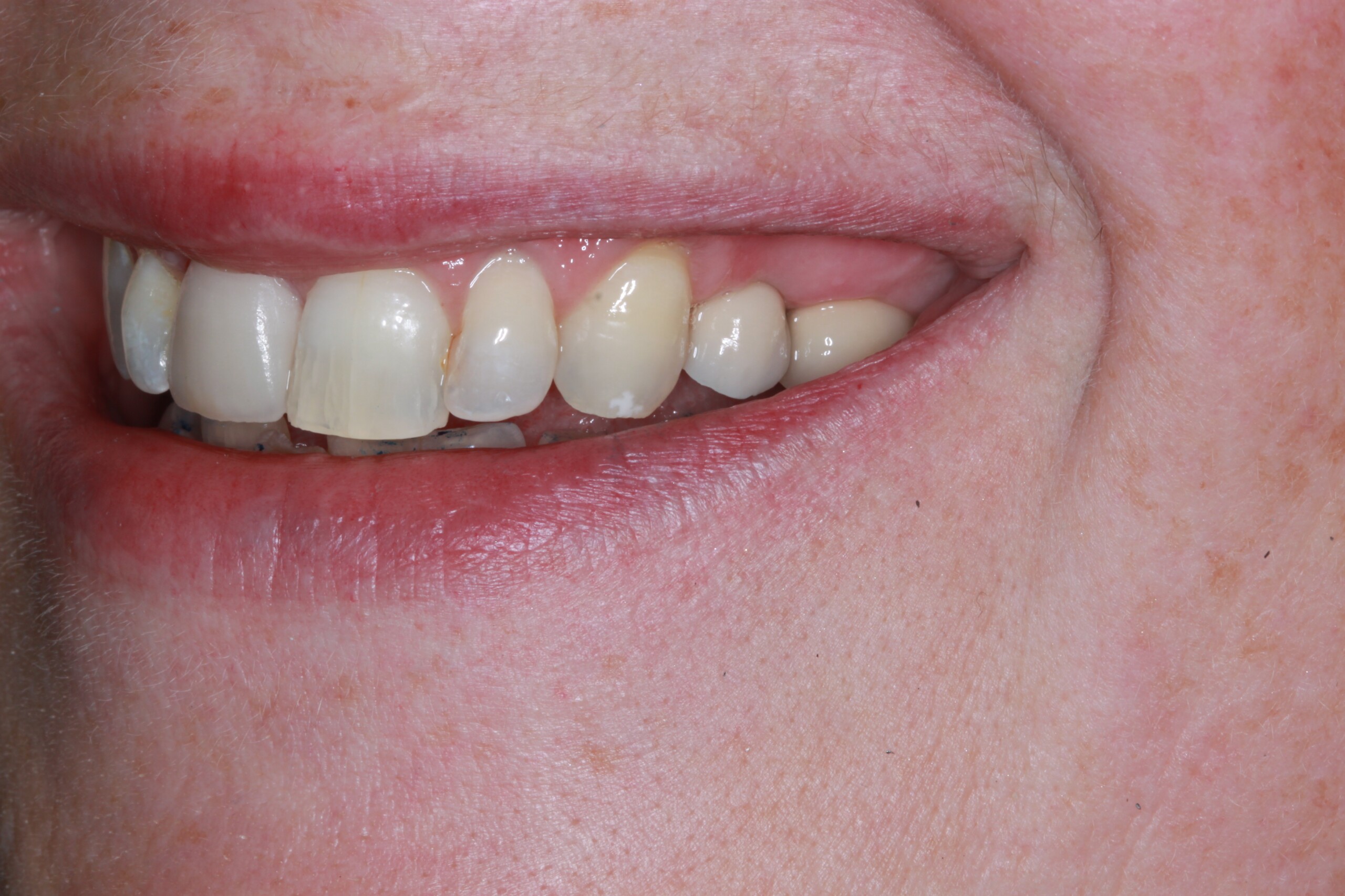 Replacing a missing tooth or teeth - Sharrow Vale Dental Care