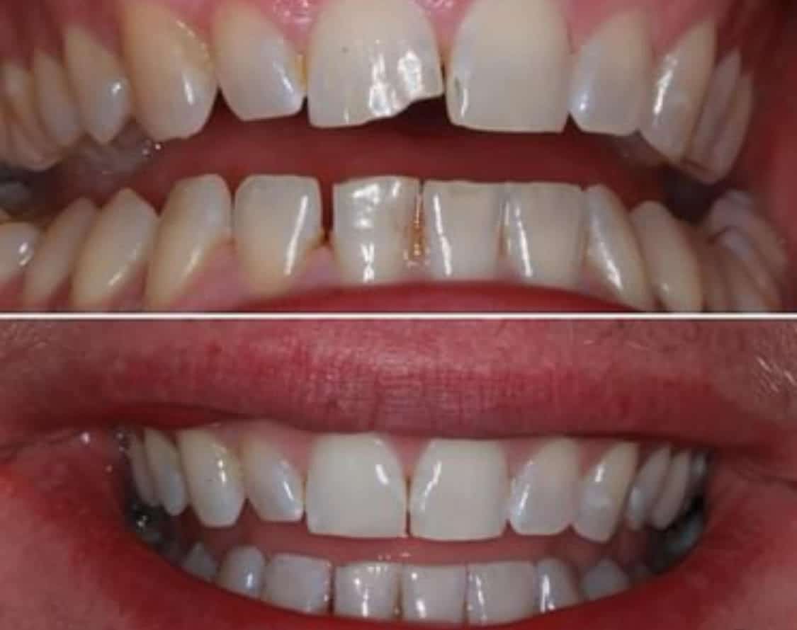 Smile Repair By Laura Webster - Sharrow Vale Dental Care