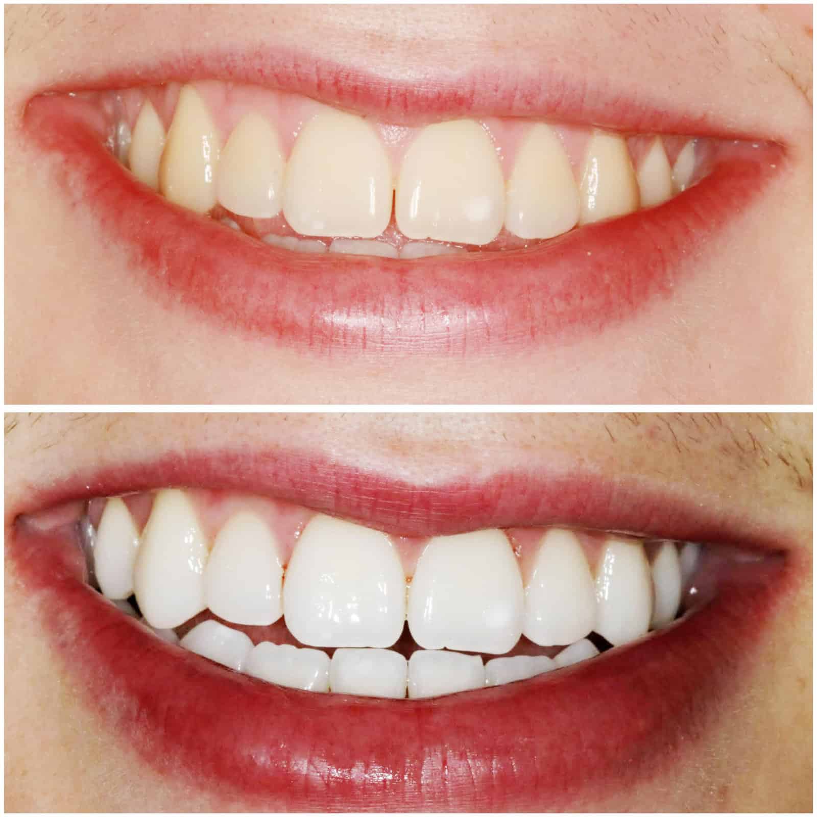 Whitening Result - Sharrow Vale Dental Care