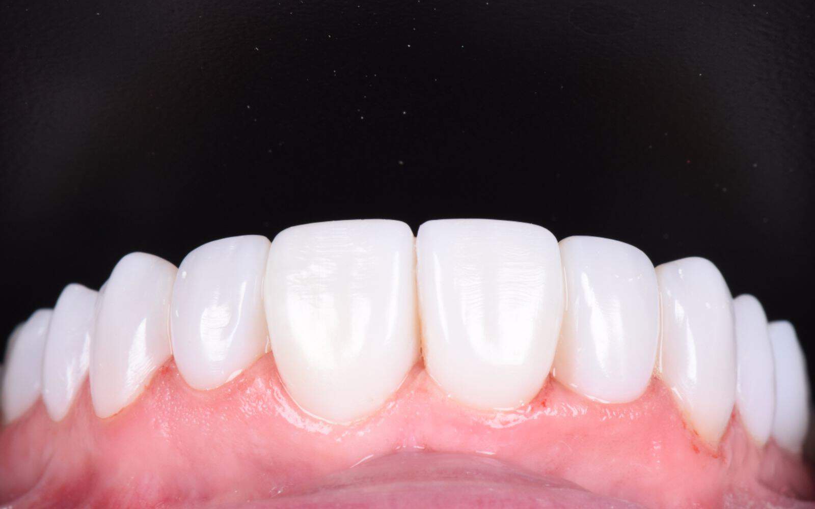 What Is Composite Bonding - Sharrow Vale Dental Care