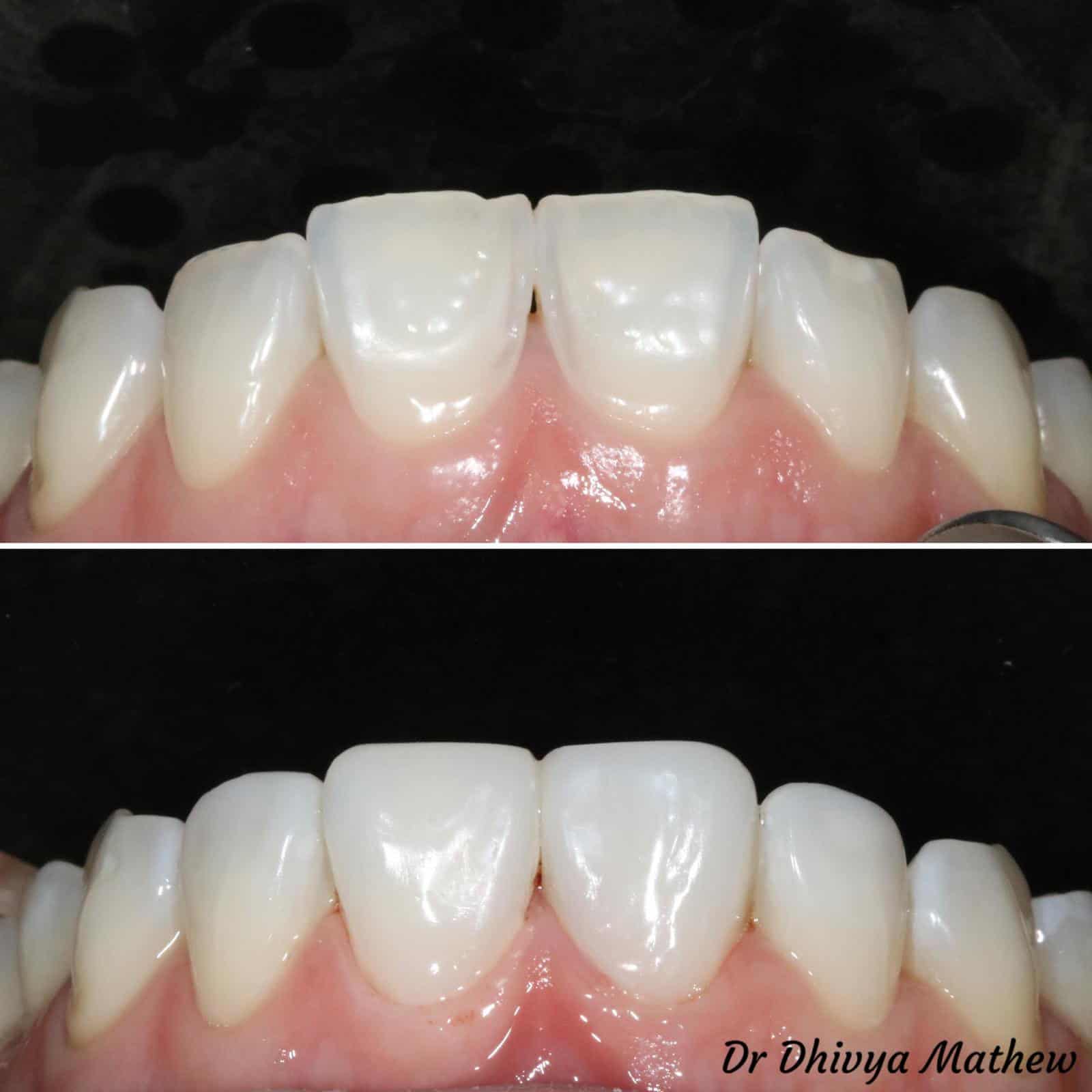 Before & After - Dr Dhivya Mathew - Sharrow Vale Dental Care