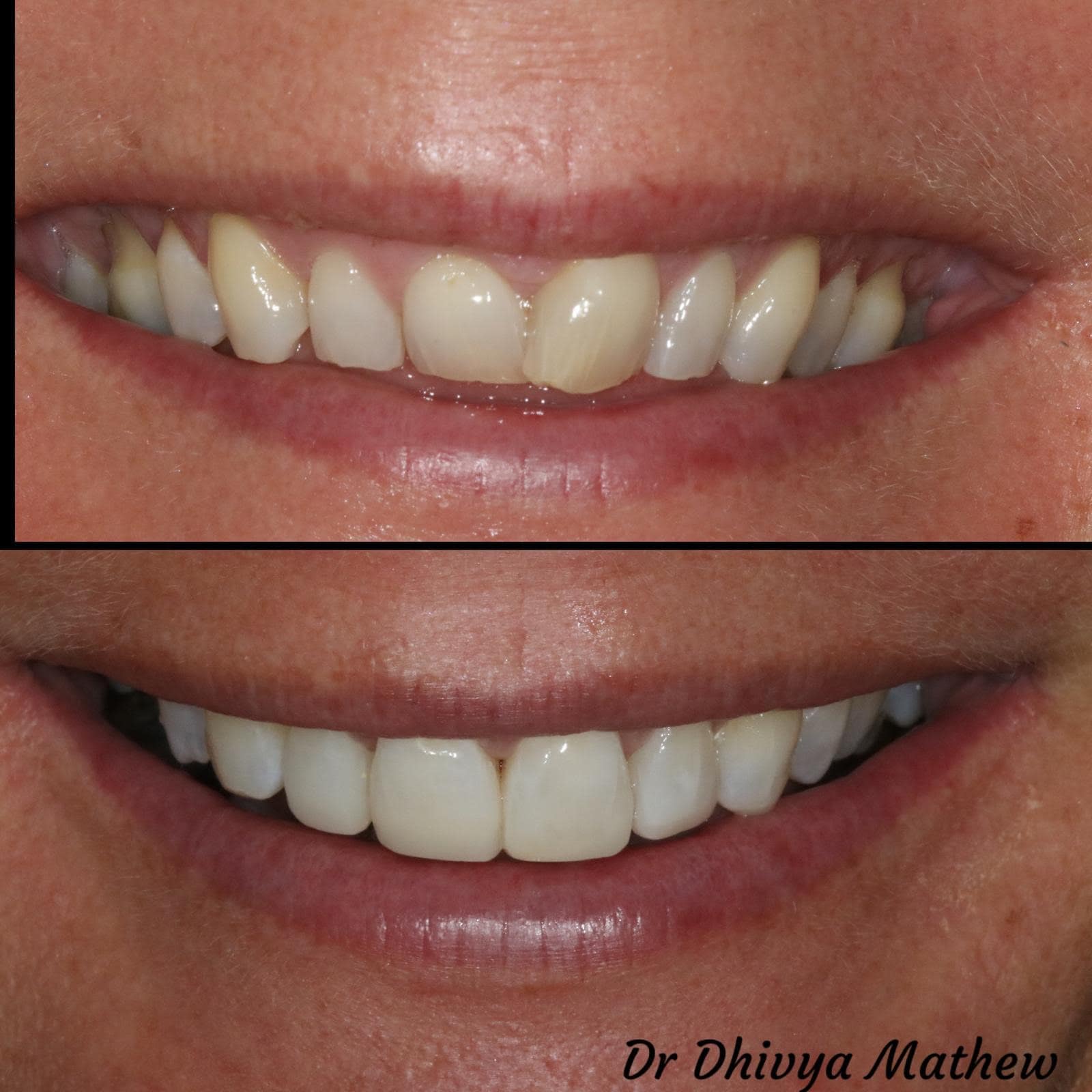 Before & After - Sharrow Vale Dental Care