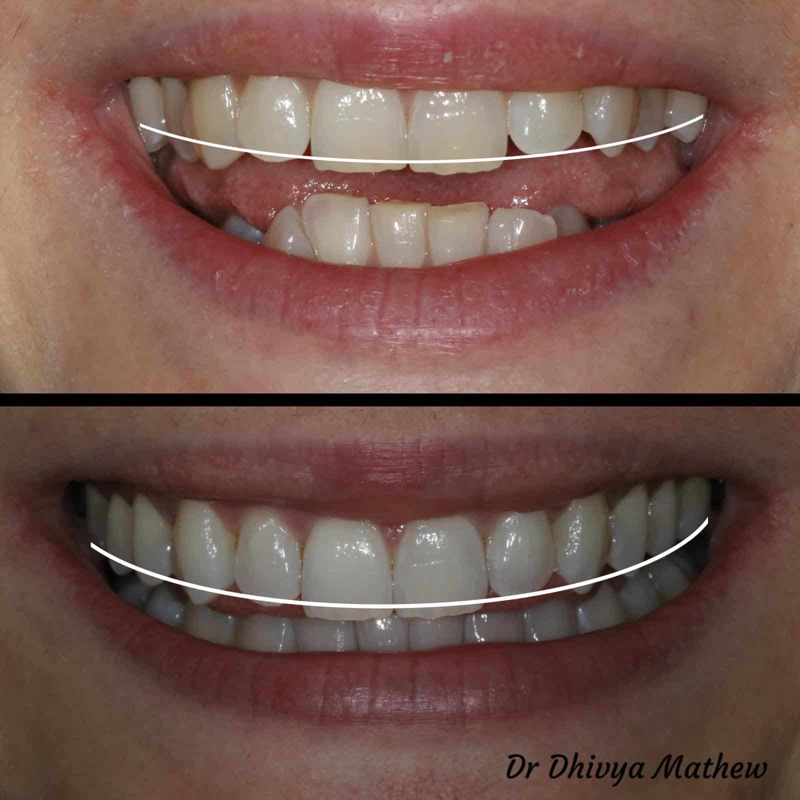 What Makes A Beautiful Smile? - Sharrow Vale Dental Care