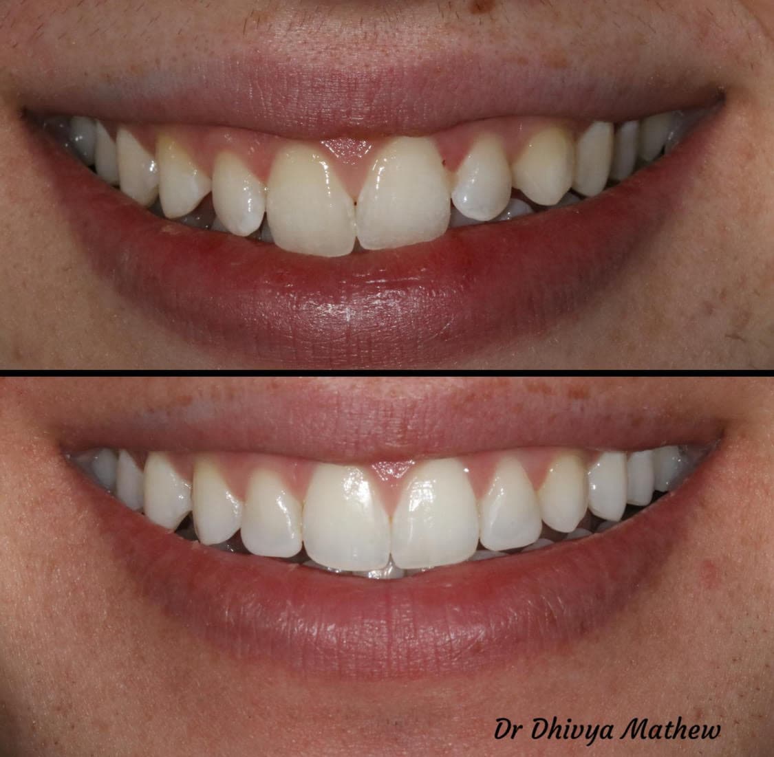 Invisalign & Composite Bonding - Dr Dhivya Mathew - Sharrow Vale Dental ...