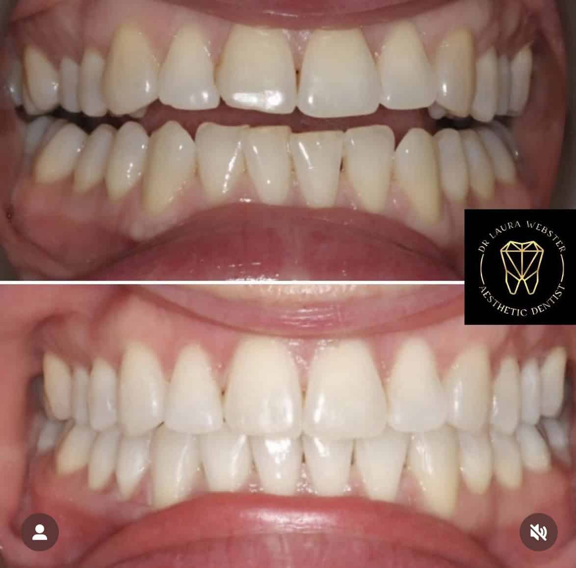 Invisible Invisalign - Sharrow Vale Dental Care