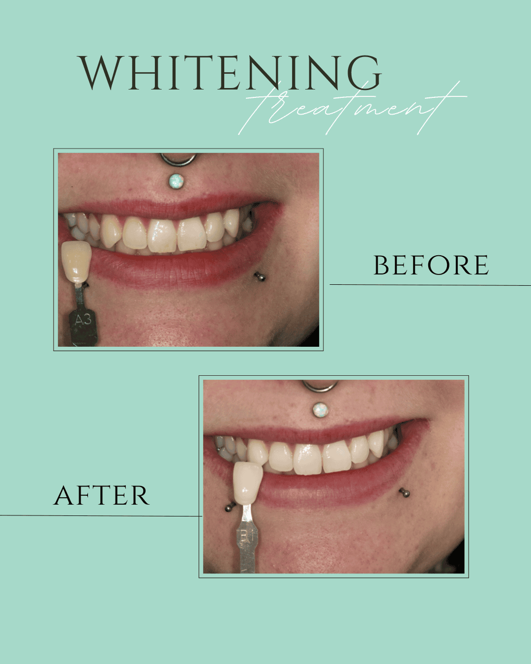 Before & After - Sharrow Vale Dental Care