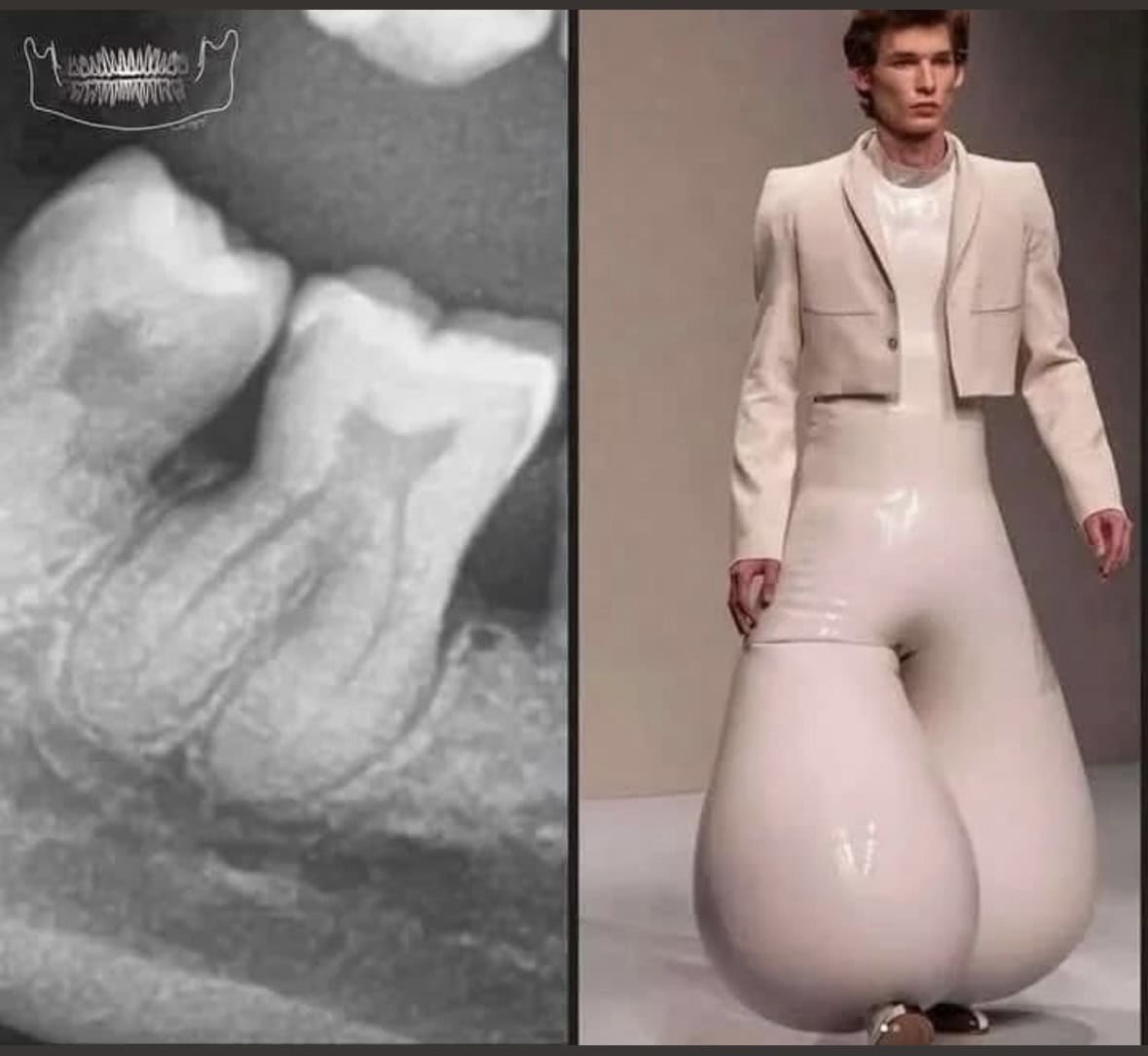 Hypercementosis - Sharrow Vale Dental Care